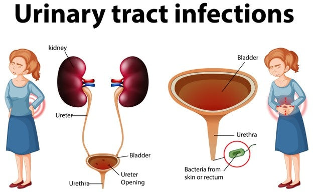 Understanding Urinary Tract Infections (UTIs) – Cate's Chemist